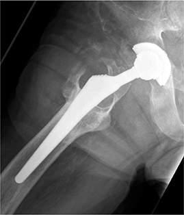 Minimum 20-year follow-up of a press-fit acetabular cup in cementless ...