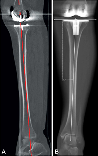 3-dimensional computer tomography is more accurate than traditional ...