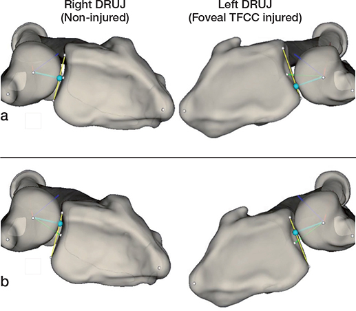 Distal radioulnar joint kinematics before surgery and 12 months ...