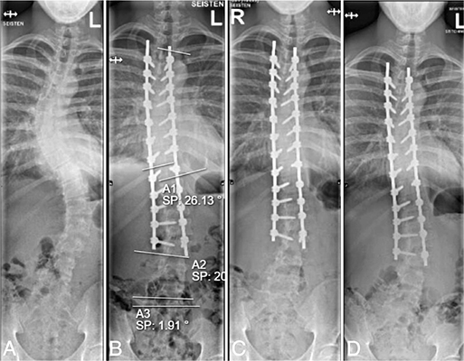 Mechanical axial instability of segmental pedicle screw instrumentation ...