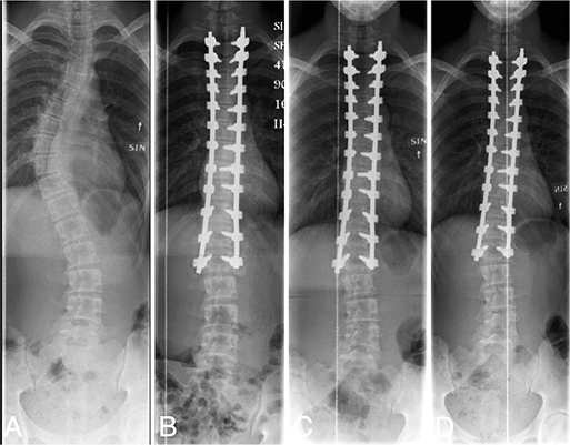 Mechanical axial instability of segmental pedicle screw instrumentation ...